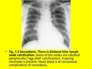 7 diffuse lung disease | PPTX