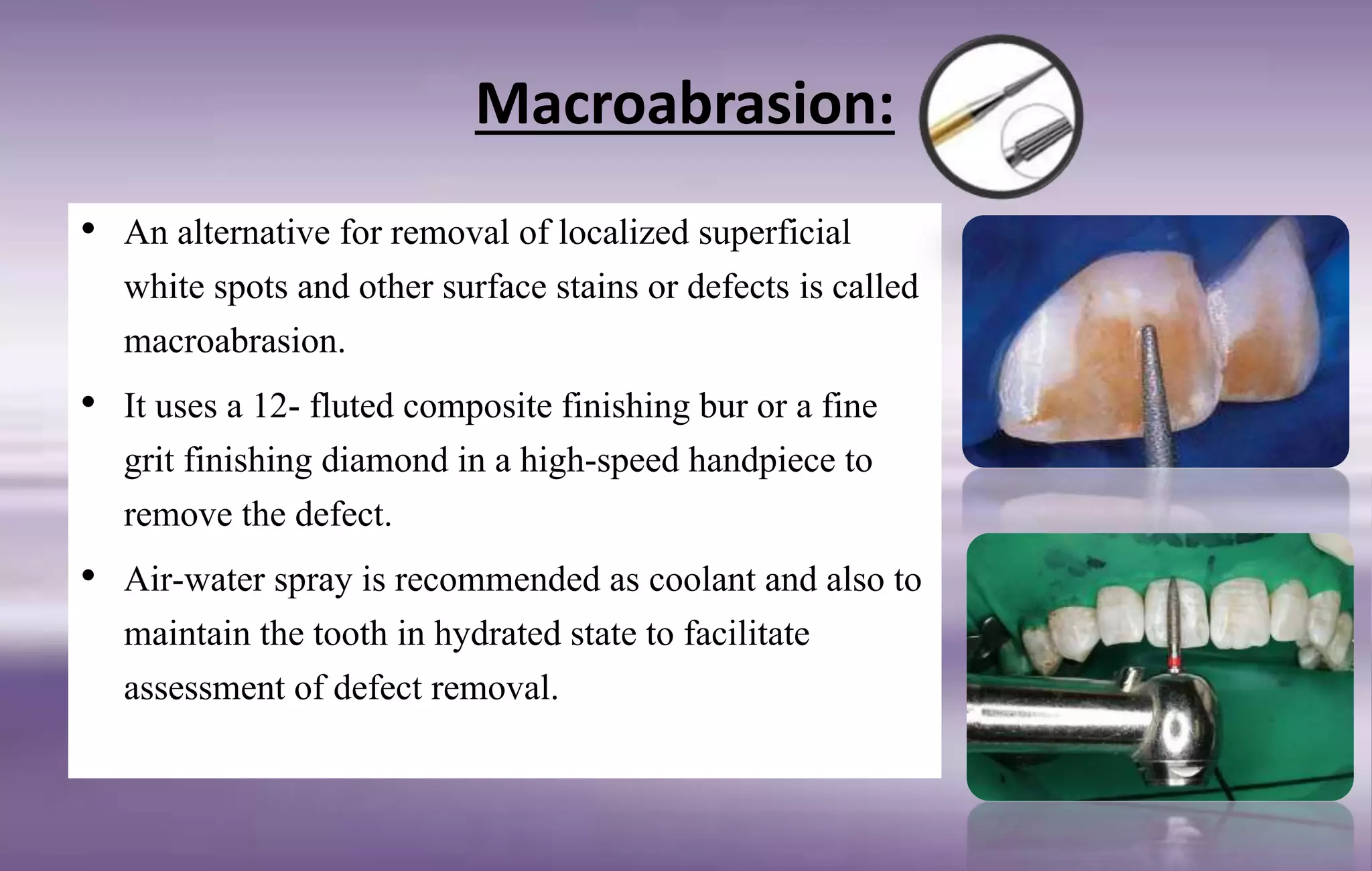 discoloration of teeth and management | PPTX