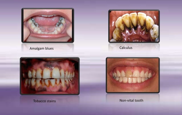 discoloration of teeth and management | PPTX | Oral care | Personal Care