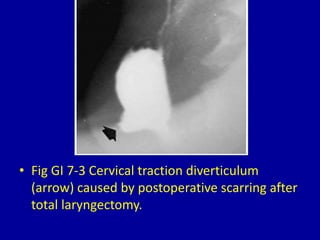7 esophageal diverticula | PPTX