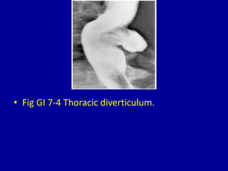 7 esophageal diverticula | PPTX