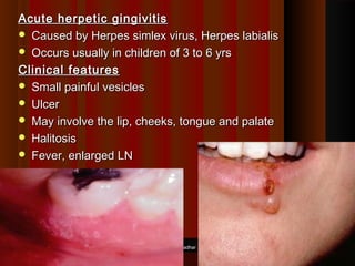 7gingivitis | PPT