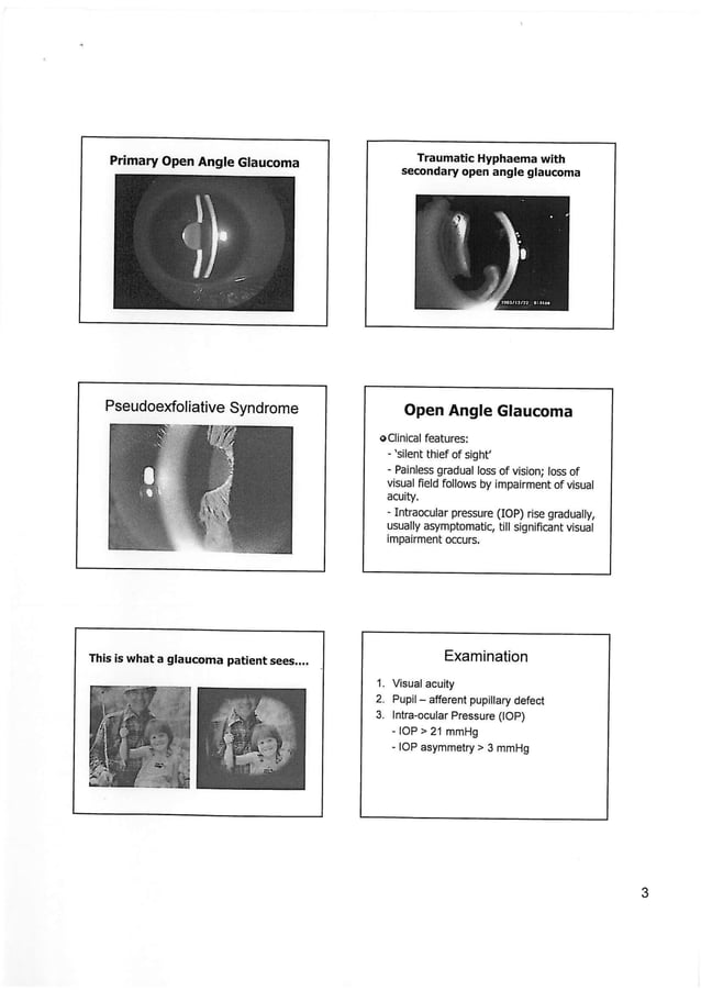 Glaucoma and management | PDF
