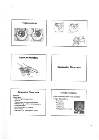 Glaucoma and management | PDF