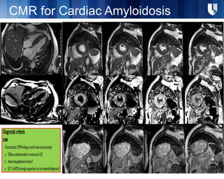 Cardiac Amyloidosis: Diagnostic & Therapeutic Approaches | PPTX
