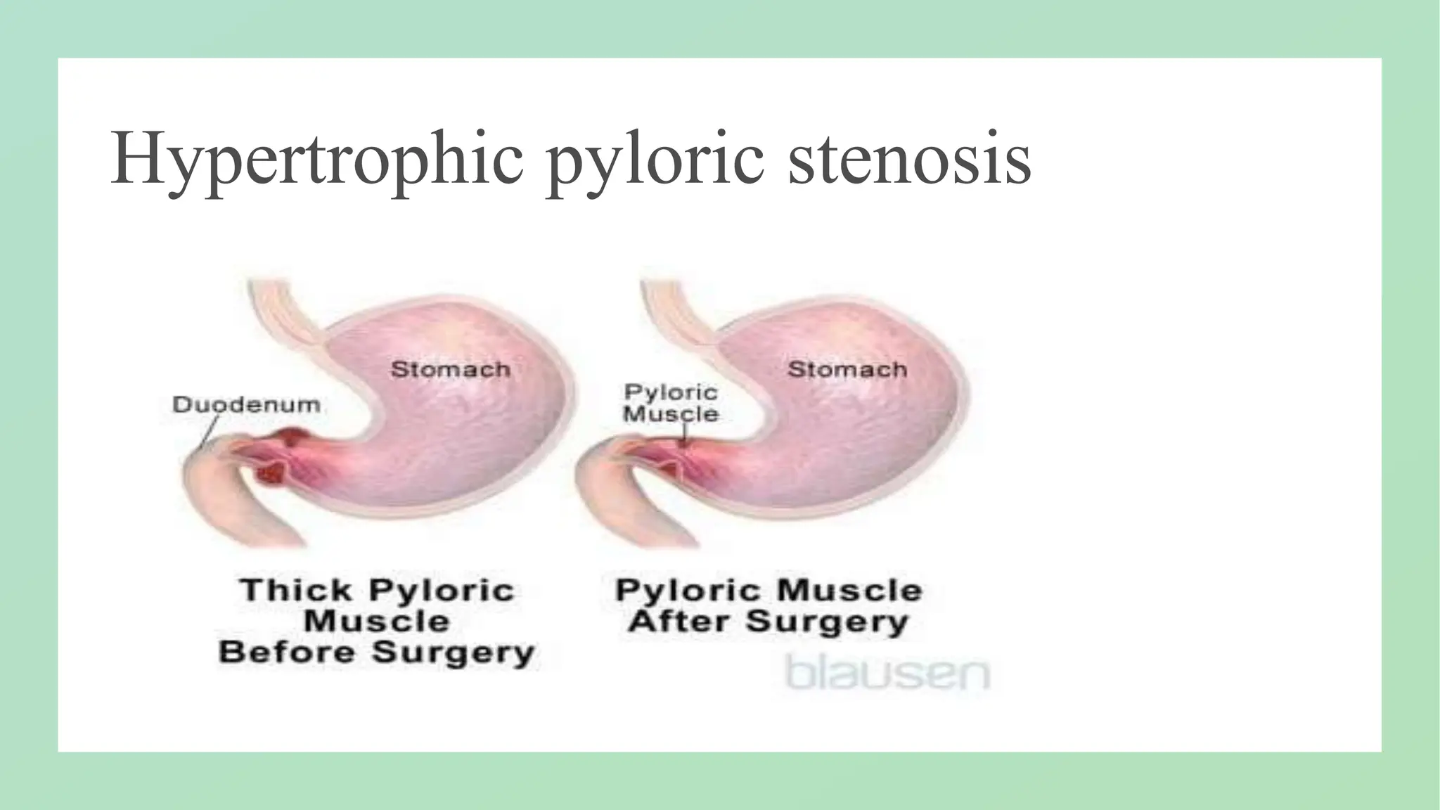 Hypertrophic pyloric stenosis (HPS).pptx