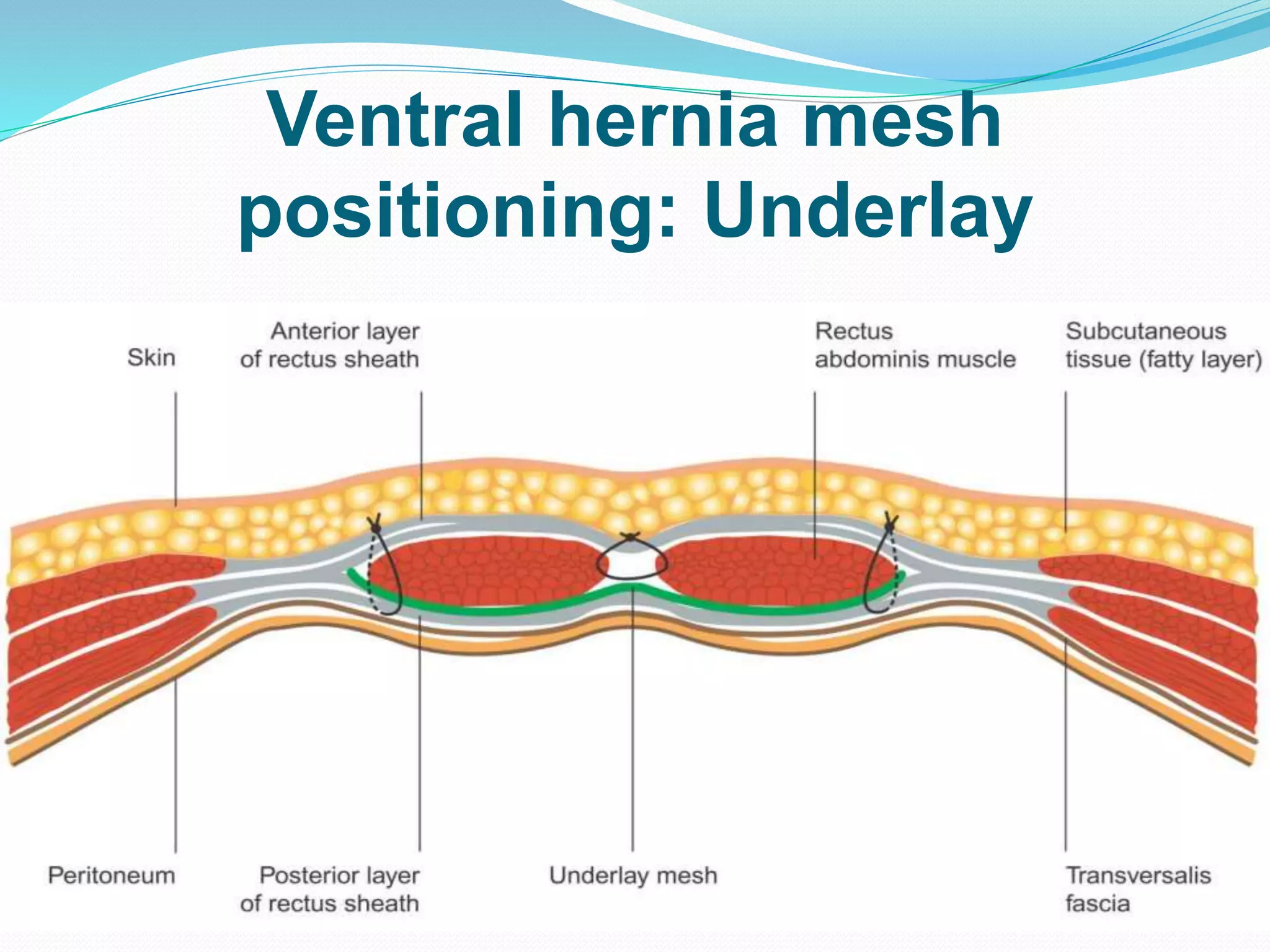 Types of mesh & complications | PPTX