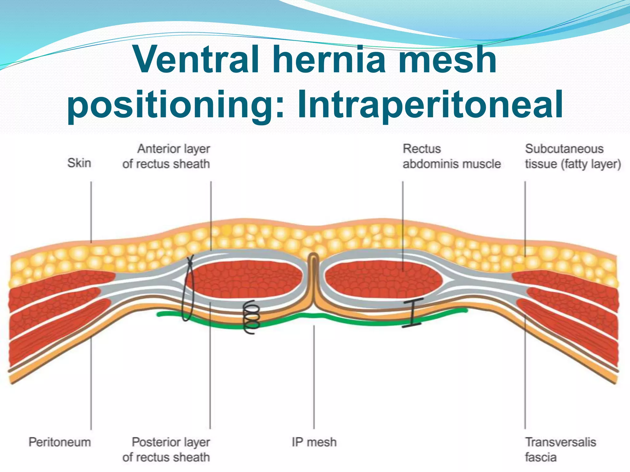 Types of mesh & complications | PPTX