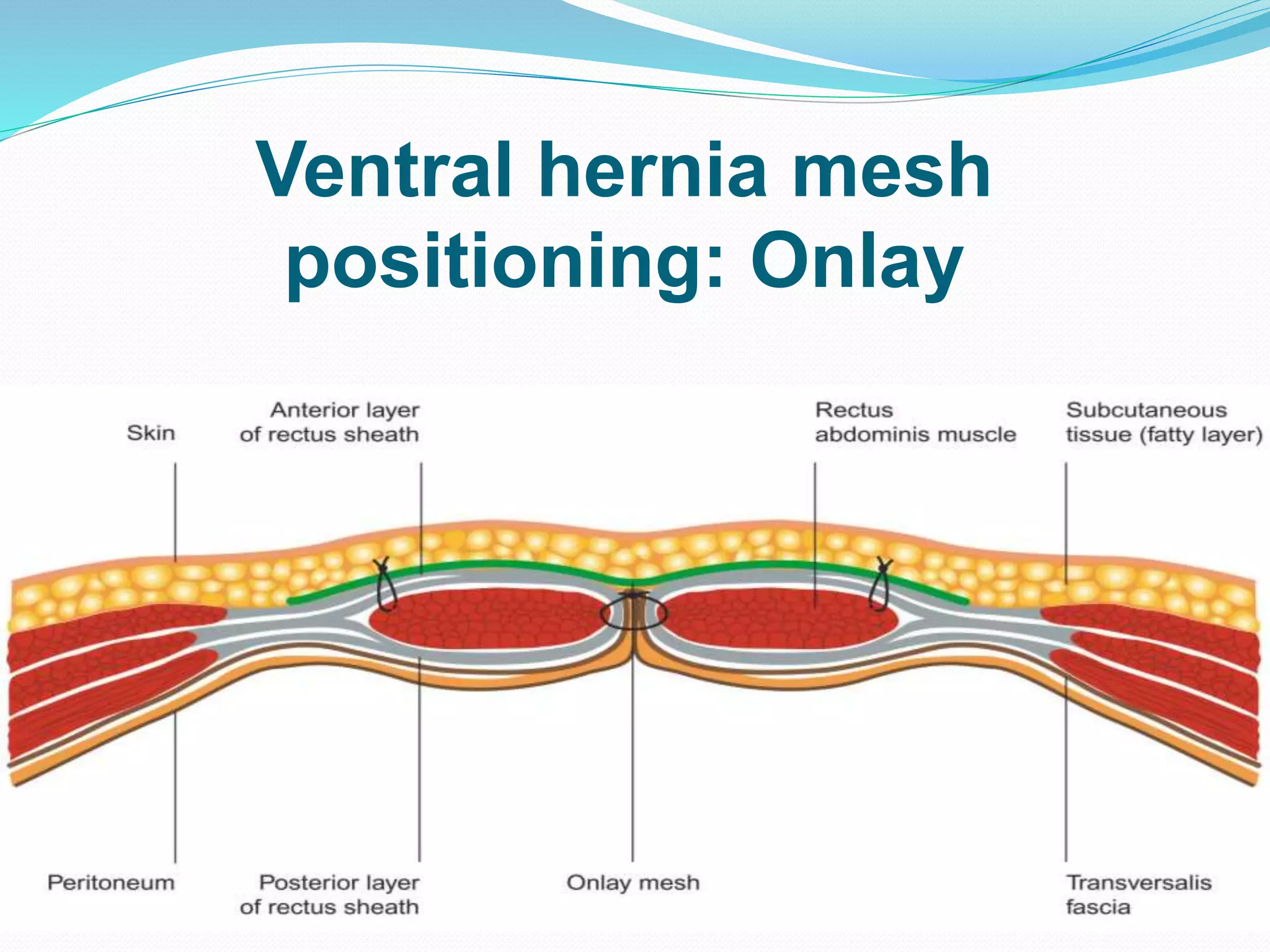 Types of mesh & complications | PPTX