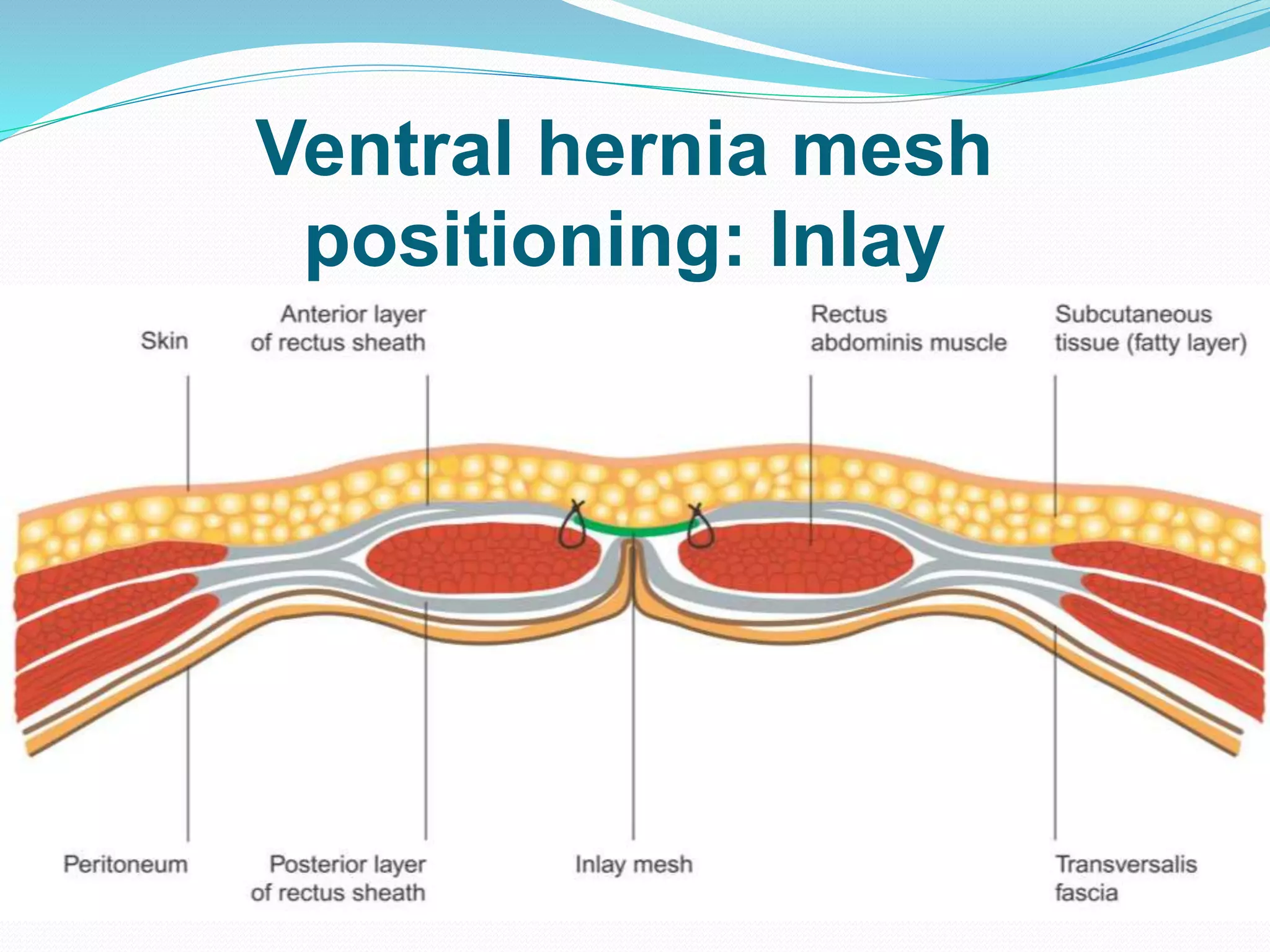 Types of mesh & complications | PPTX
