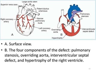 Heart Defects | PPTX