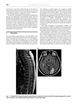 A case of Neuromyelitis optica as a presenting manifestation of ...