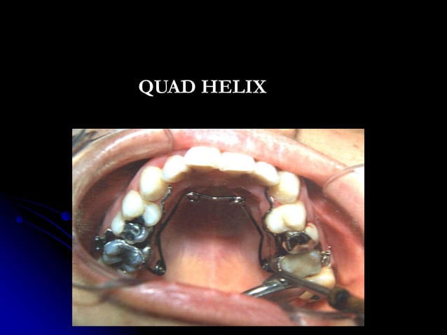 septima CLASE laboratorio en ortodoncia y ortopedia maxilar sobre QUAD ...
