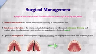 Management of Cleft Lip and Cleft Palate | PDF