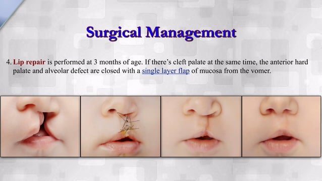 Management of Cleft Lip and Cleft Palate | PPT