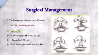 Management of Cleft Lip and Cleft Palate | PPT