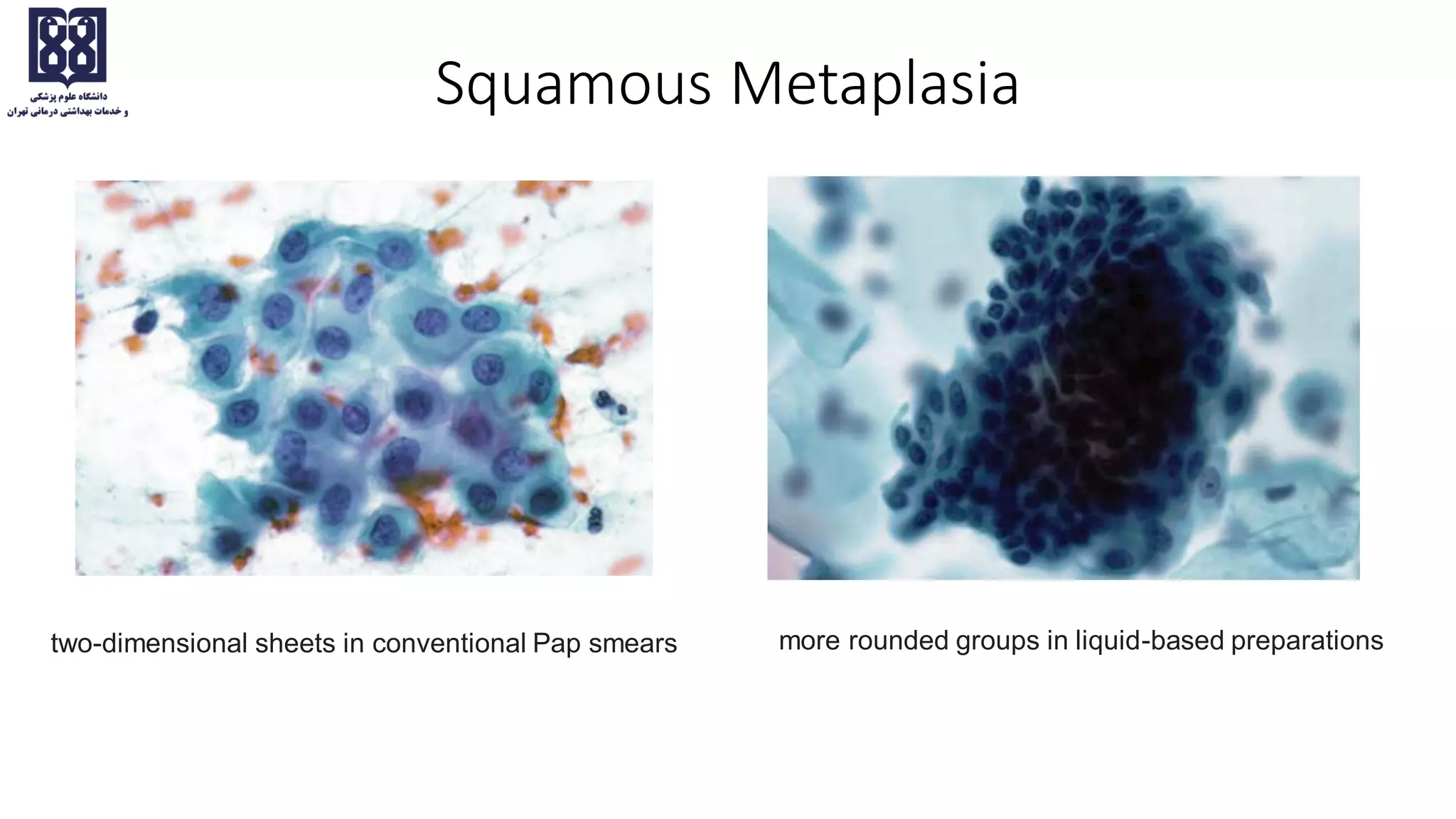 Pap smaer cytology | PDF
