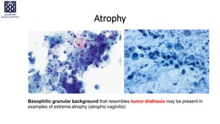 Atrophic Vaginitis Cytology