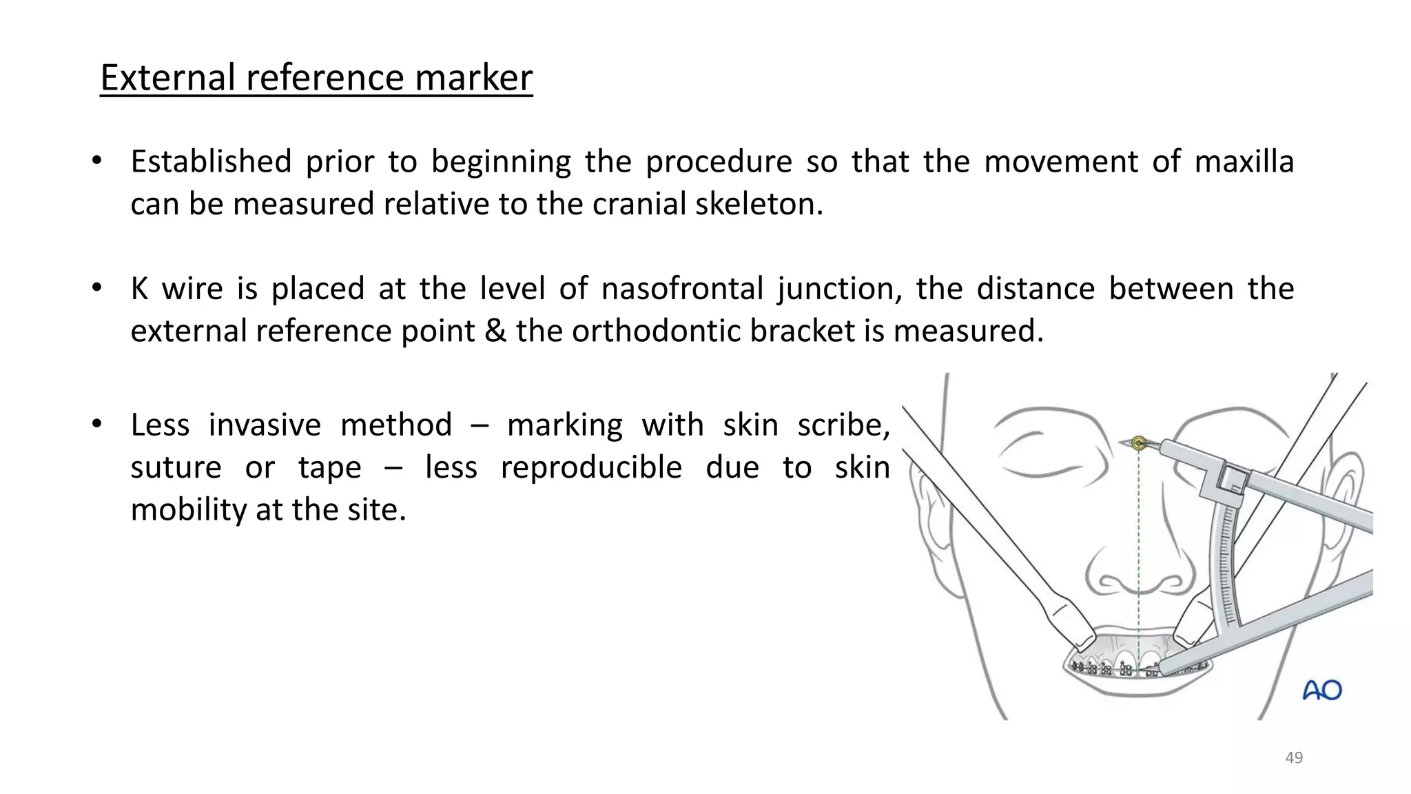 7 MIDFACE ORTHOGNATHIC PROCEDURE seminar 7.pptx