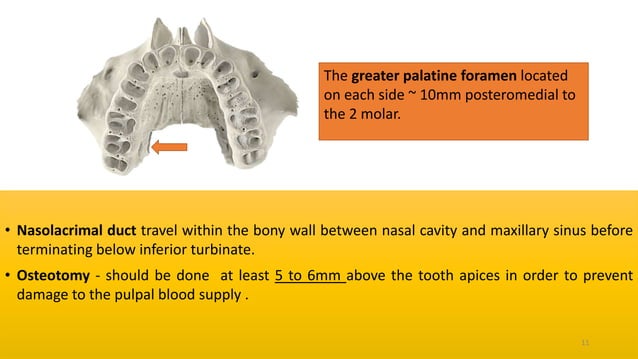 7 MIDFACE ORTHOGNATHIC PROCEDURE seminar 7.pptx | Ear, Nose and Throat ...