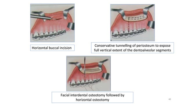 7 MIDFACE ORTHOGNATHIC PROCEDURE seminar 7.pptx | Ear, Nose and Throat ...