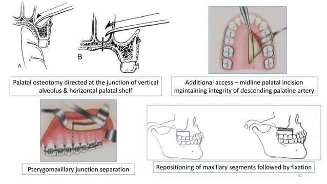 7 MIDFACE ORTHOGNATHIC PROCEDURE seminar 7.pptx | Ear, Nose and Throat ...
