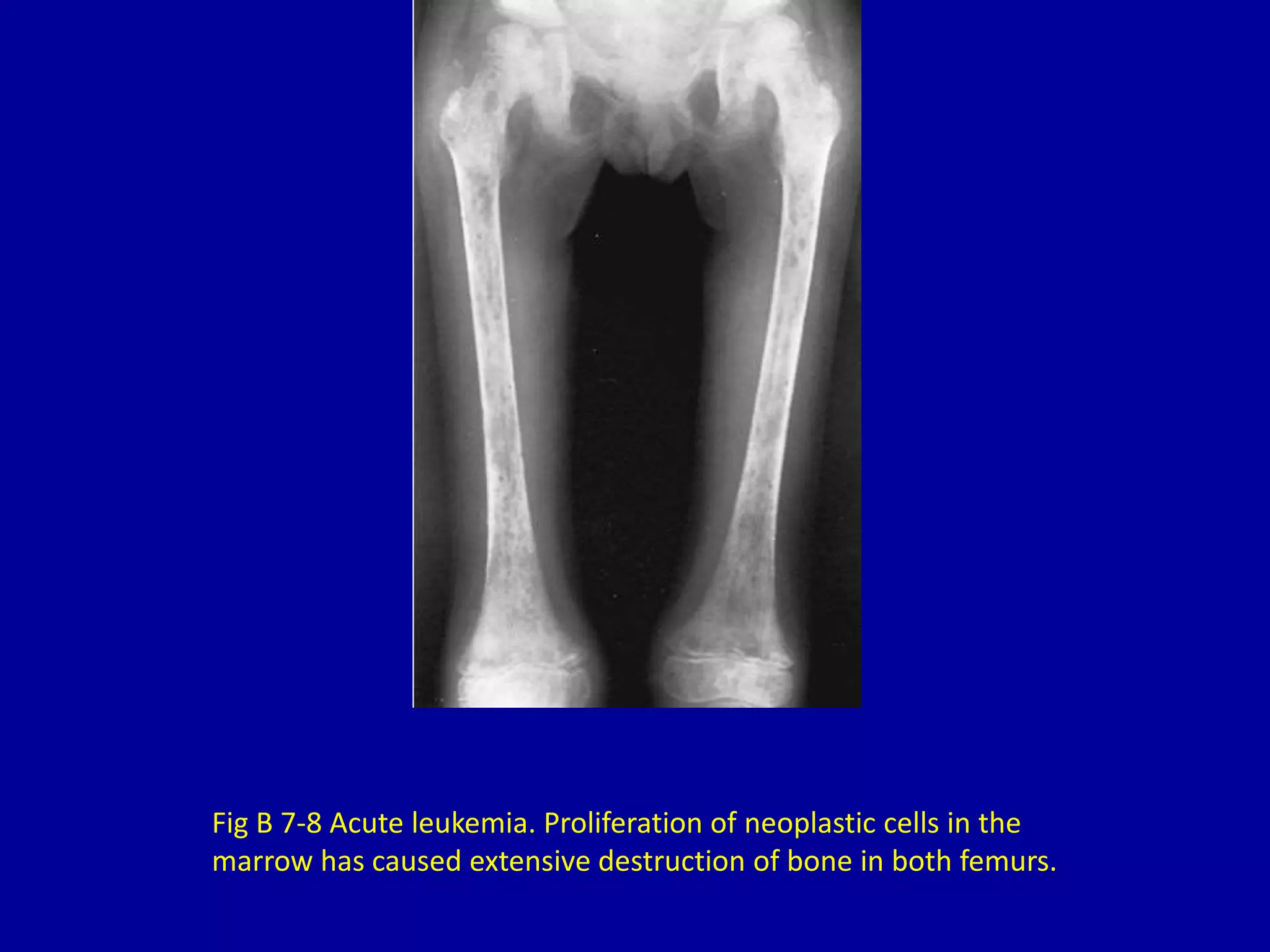 7 moth eaten or punched-out osteolytic destructive lesions of | PPTX