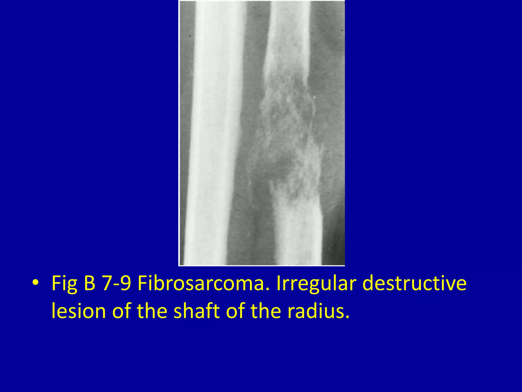 7 moth eaten or punched-out osteolytic destructive lesions of | PPTX