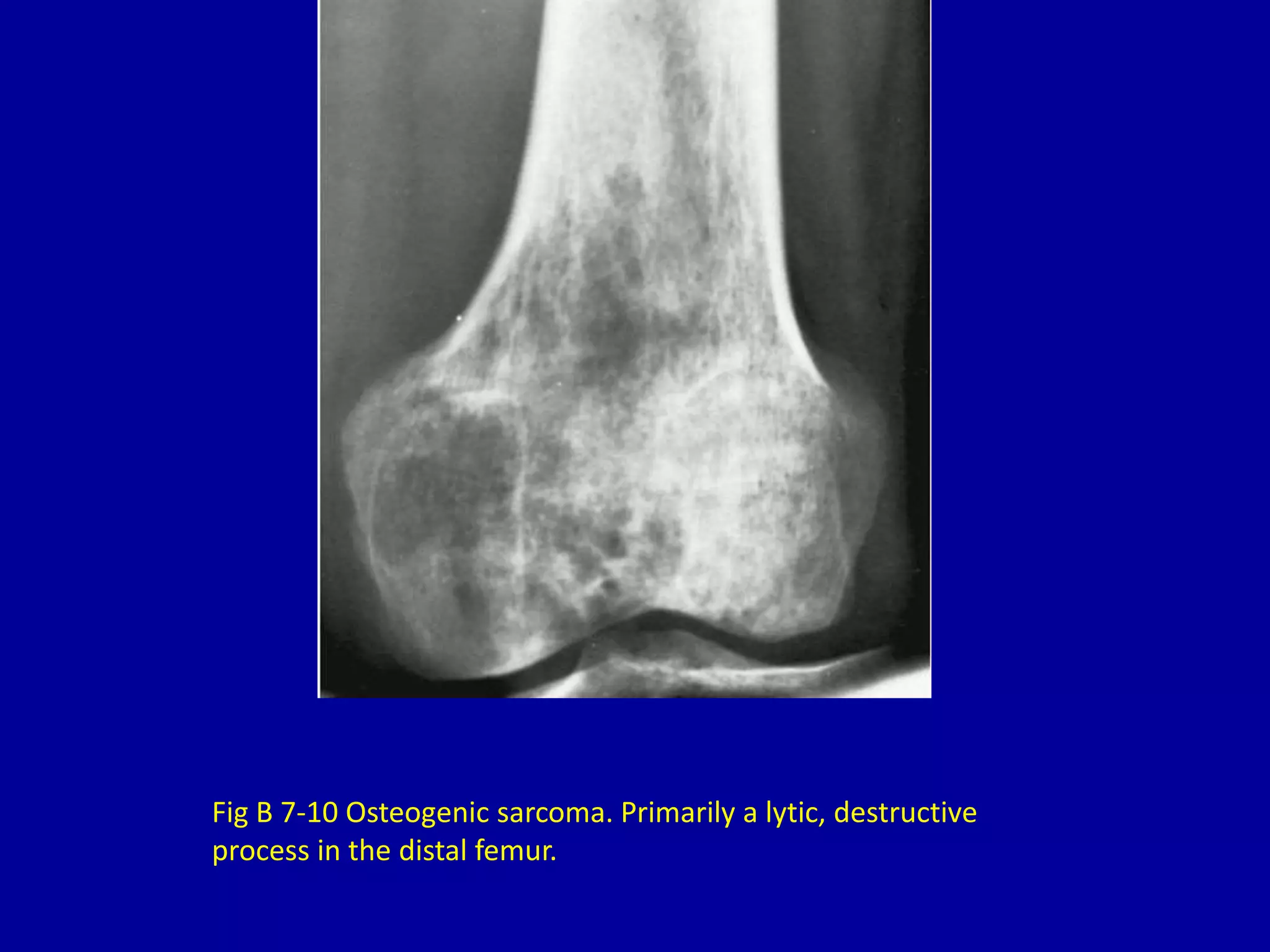 7 moth eaten or punched-out osteolytic destructive lesions of | PPTX