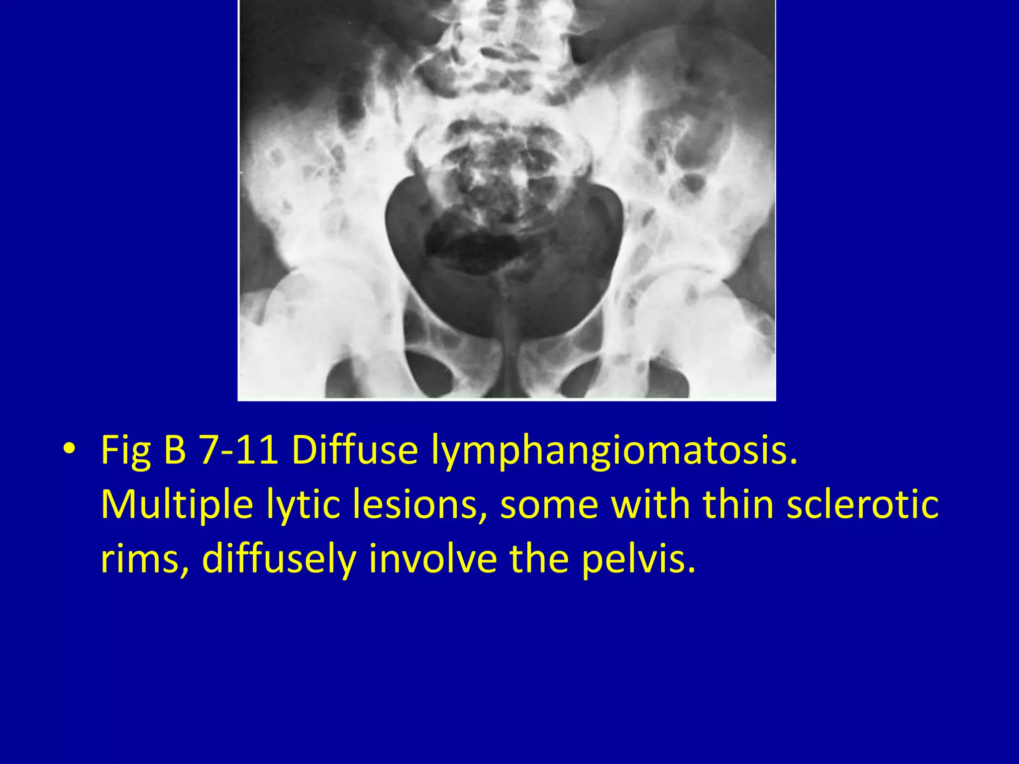 7 moth eaten or punched-out osteolytic destructive lesions of | PPTX