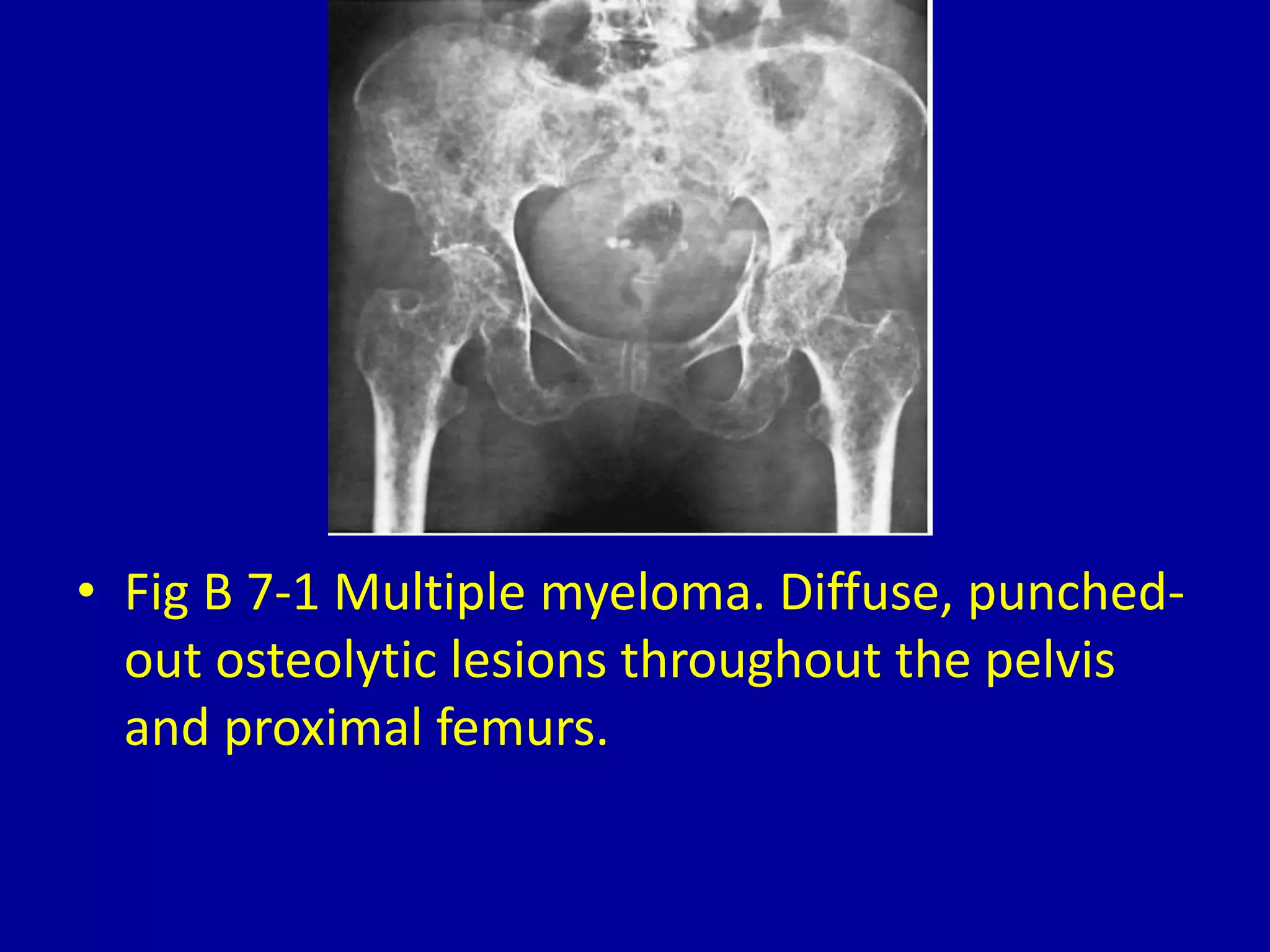 7 moth eaten or punched-out osteolytic destructive lesions of | PPTX