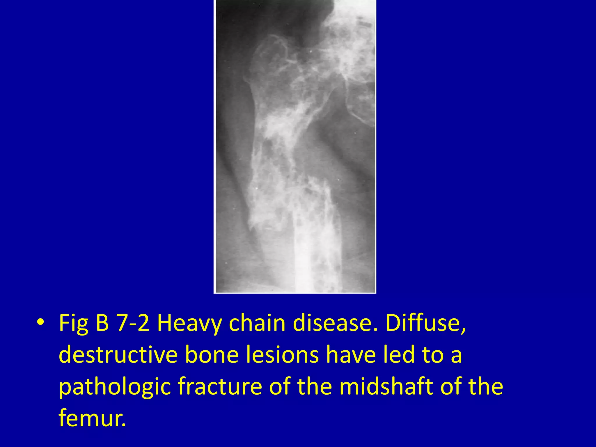 7 moth eaten or punched-out osteolytic destructive lesions of | PPTX