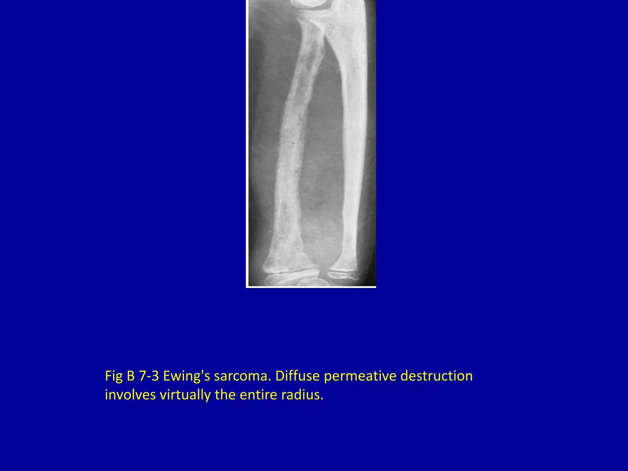 7 moth eaten or punched-out osteolytic destructive lesions of | PPTX