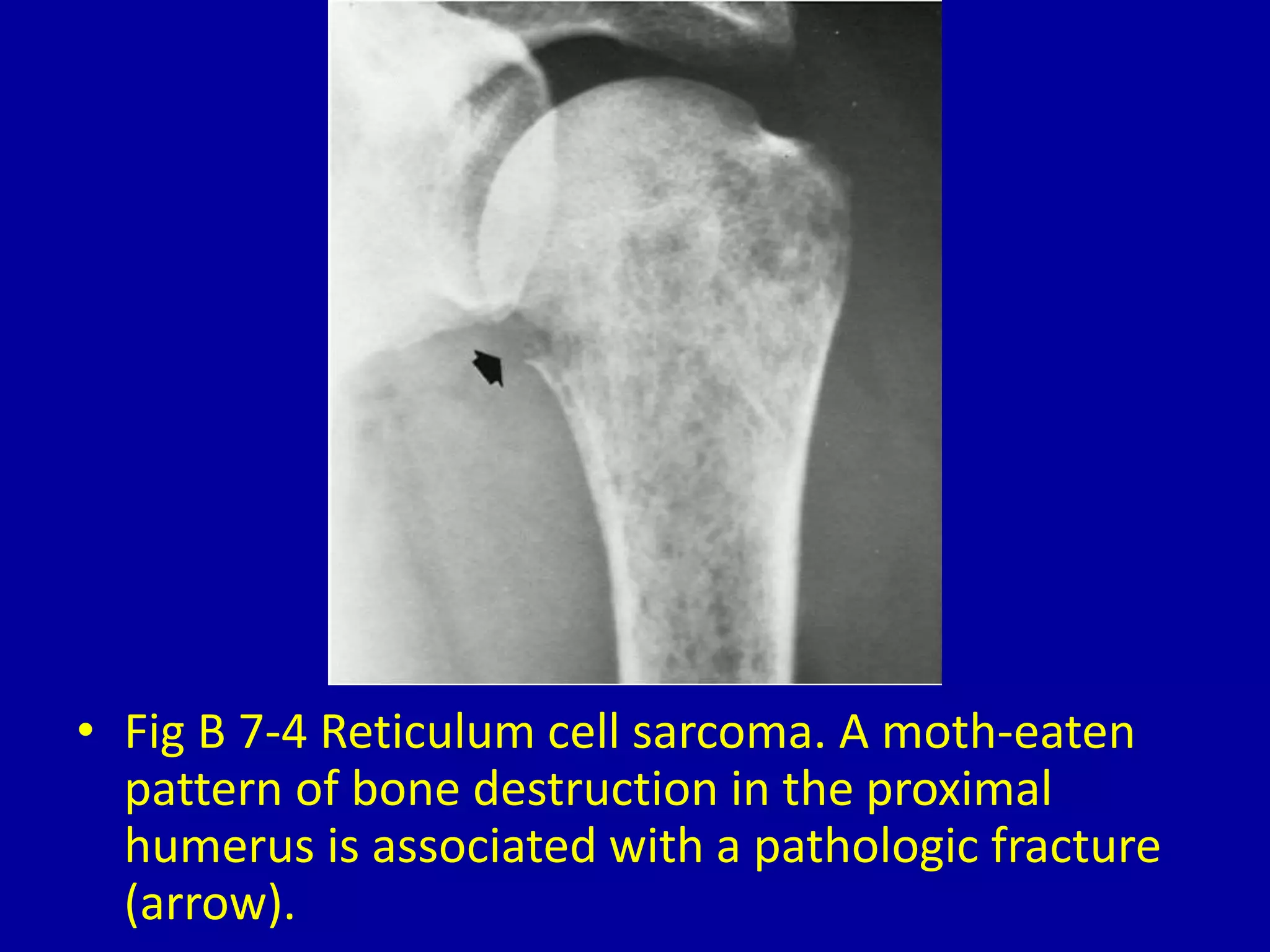7 moth eaten or punched-out osteolytic destructive lesions of | PPTX