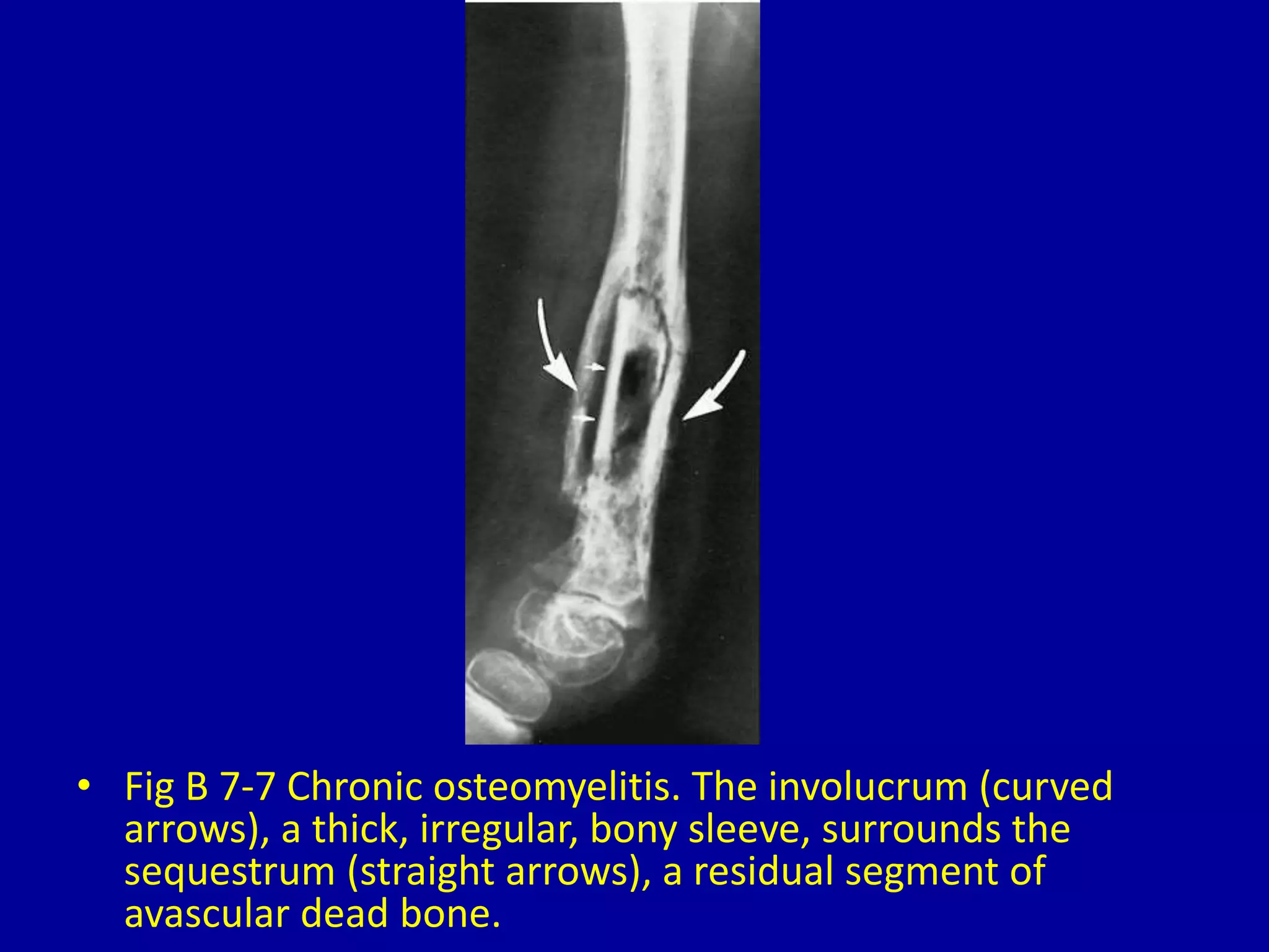 7 moth eaten or punched-out osteolytic destructive lesions of | PPTX