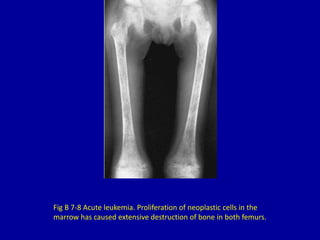 7 moth eaten or punched-out osteolytic destructive lesions of | PPTX
