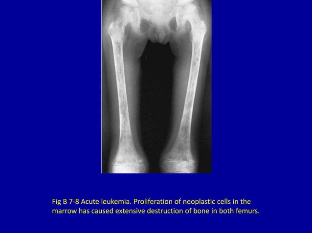 7 moth eaten or punched-out osteolytic destructive lesions of | PPTX ...