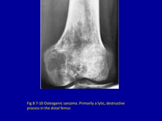 7 moth eaten or punched-out osteolytic destructive lesions of | PPTX