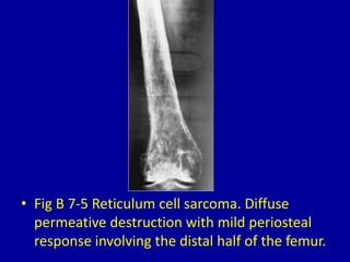 7 moth eaten or punched-out osteolytic destructive lesions of | PPTX
