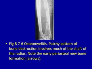 7 moth eaten or punched-out osteolytic destructive lesions of | PPTX