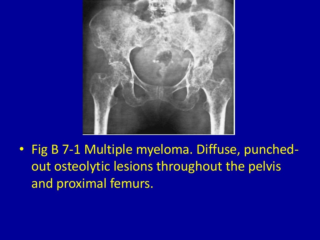 7 moth eaten or punched-out osteolytic destructive lesions of