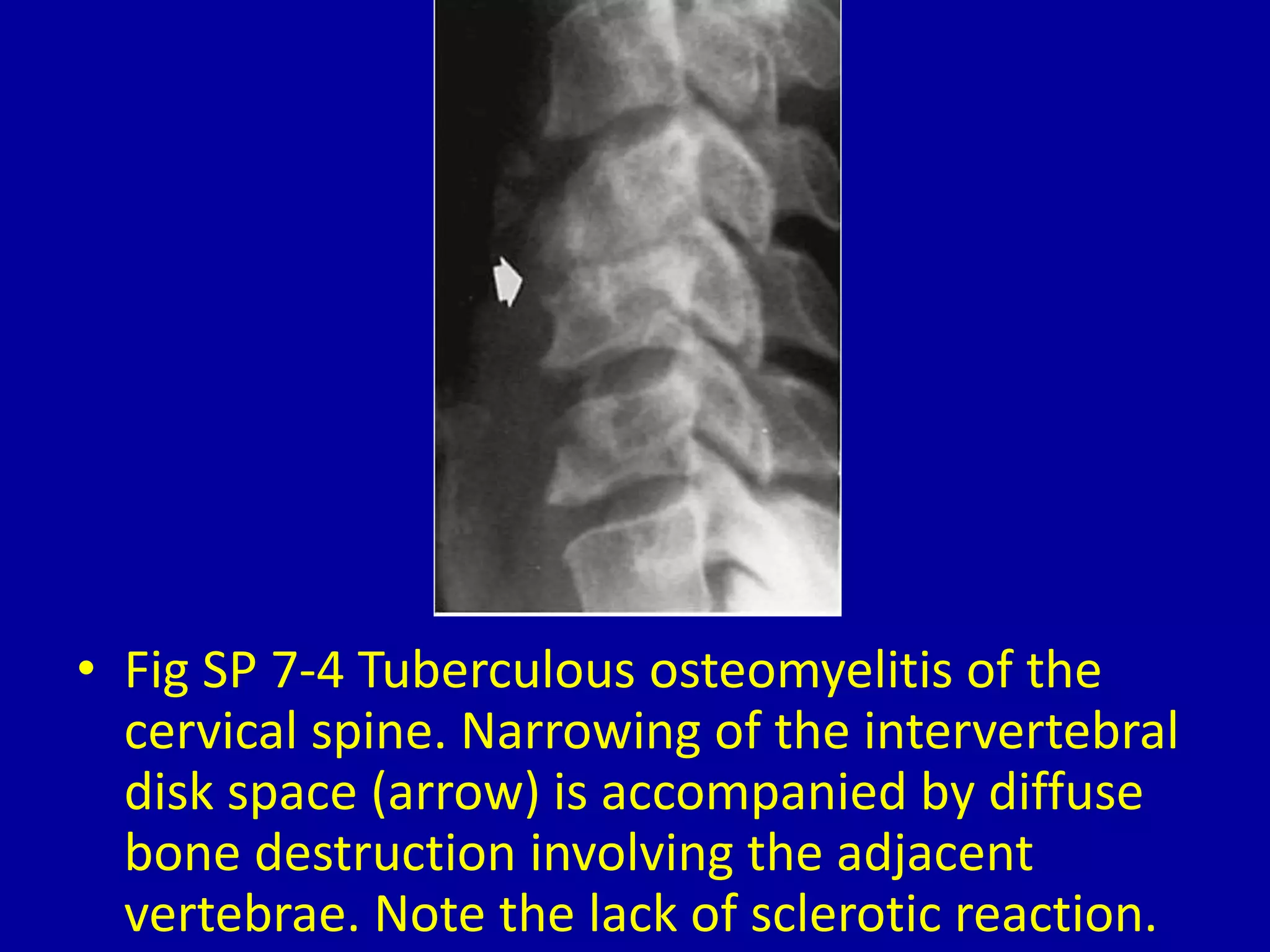 7 narrowing of the intervertebral disk space and | PPTX