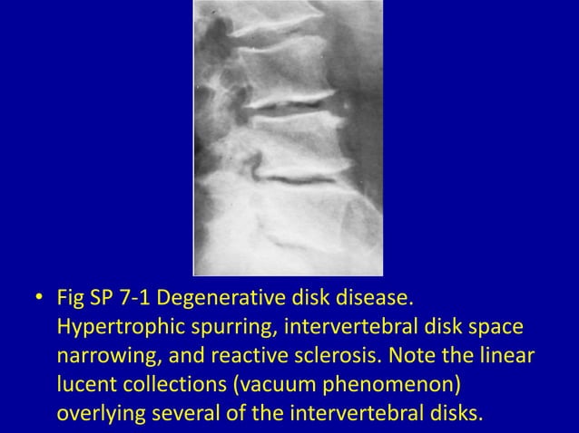7 narrowing of the intervertebral disk space and | PPT