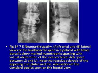 7 narrowing of the intervertebral disk space and | PPT