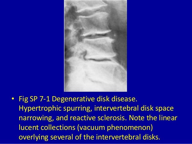 7 narrowing of the intervertebral disk space and
