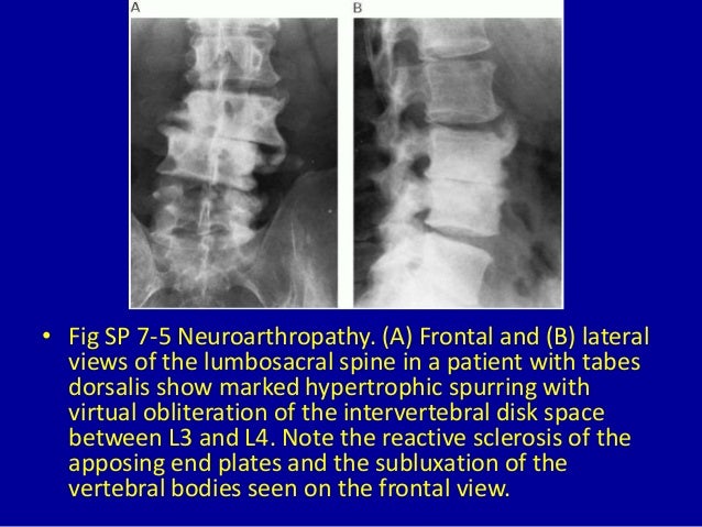 7 narrowing of the intervertebral disk space and