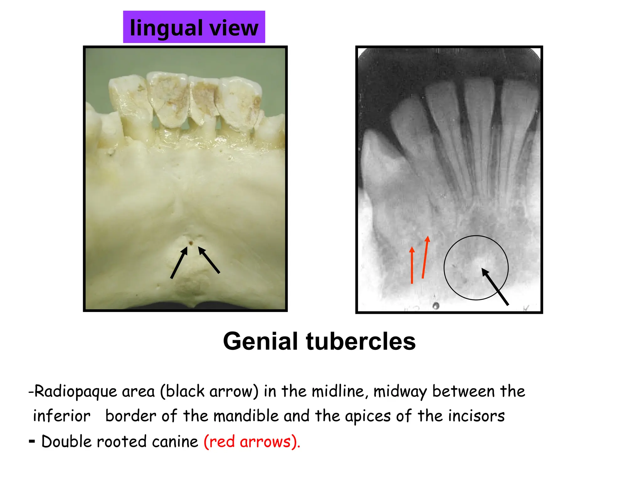 7 Normal Anatomical Landmarks OF MAXIILA AND MANDIBLE.ppt
