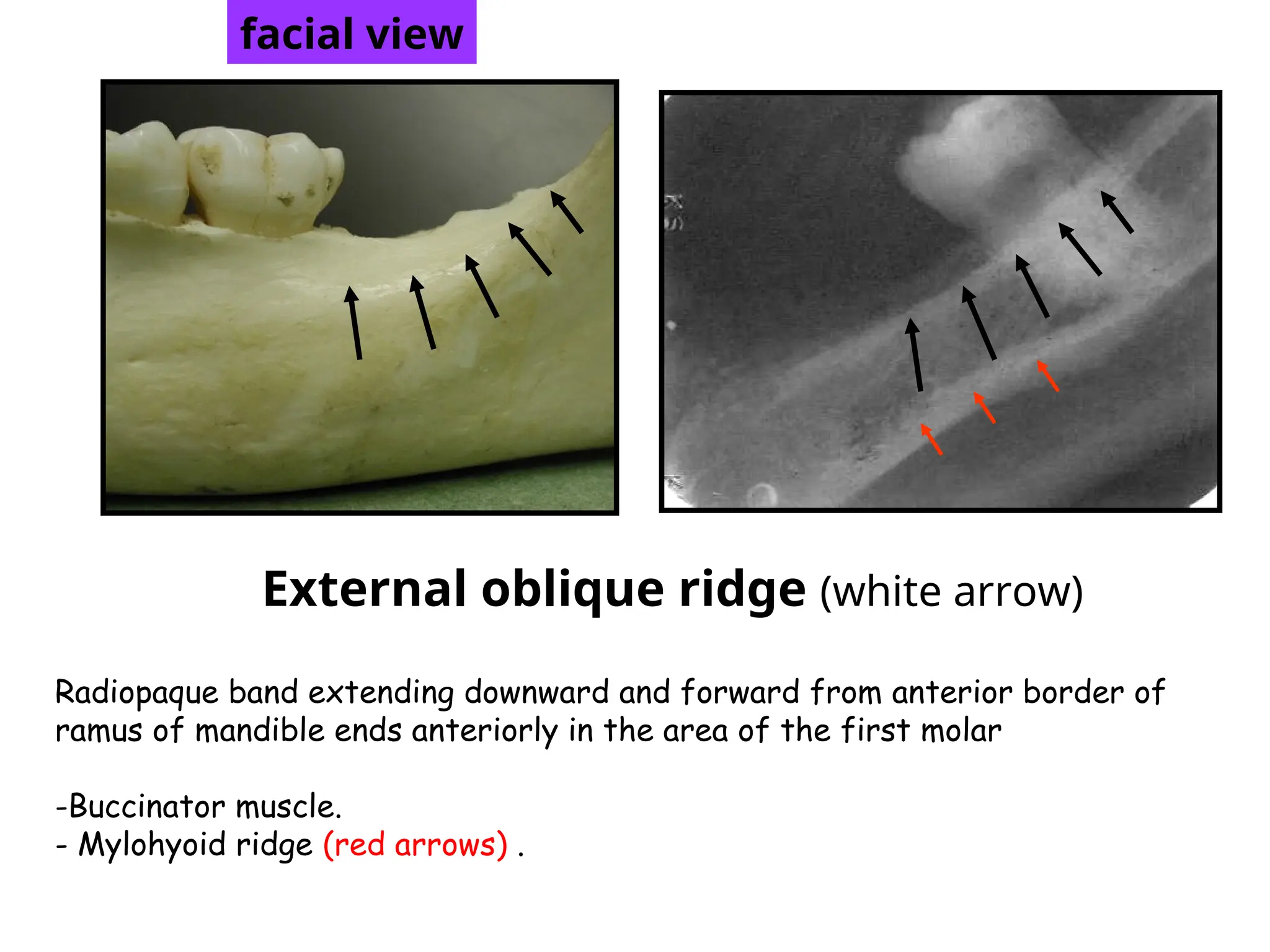 7 Normal Anatomical Landmarks OF MAXIILA AND MANDIBLE.ppt