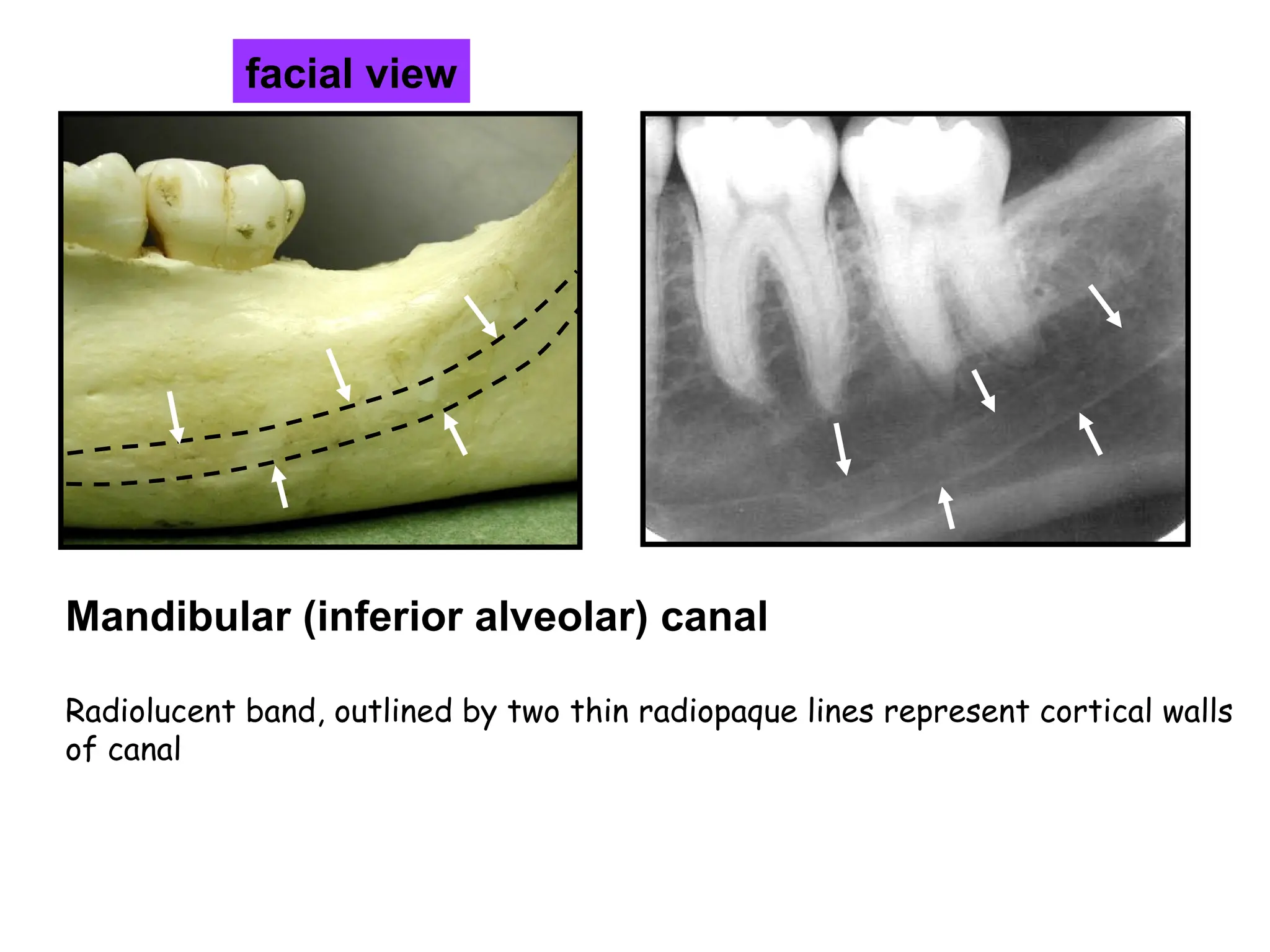 7 Normal Anatomical Landmarks OF MAXIILA AND MANDIBLE.ppt