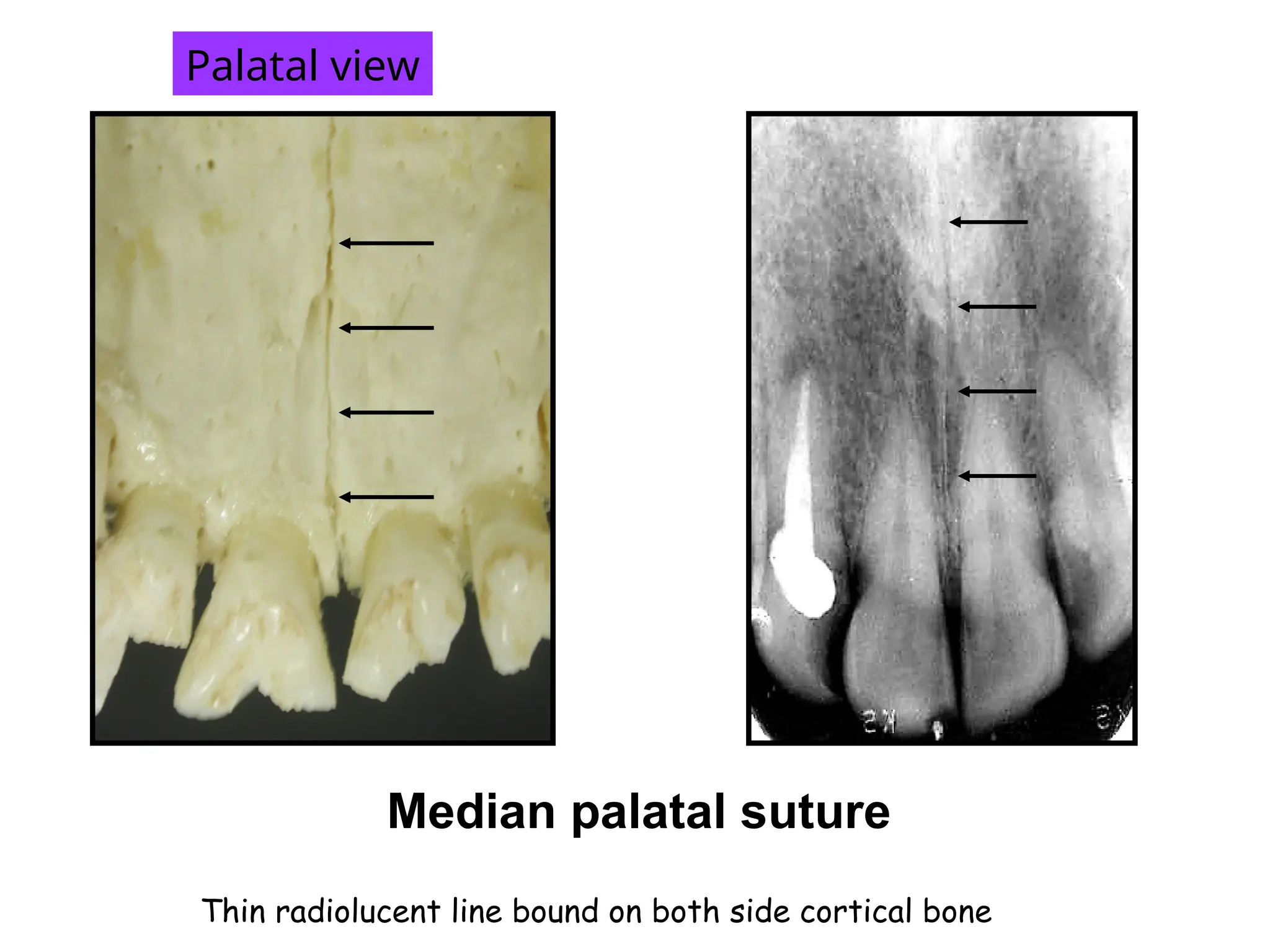 7 Normal Anatomical Landmarks OF MAXIILA AND MANDIBLE.ppt